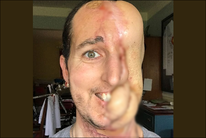 Man who lost half his face to cancer gets Terminator-style transplant